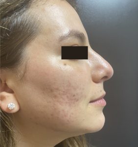 Case 10 - Acne treatment | Hudson Dermatology and Laser Surgery