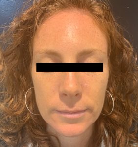 Case 17 - Micropeel treatment | Hudson Dermatology and Laser Surgery