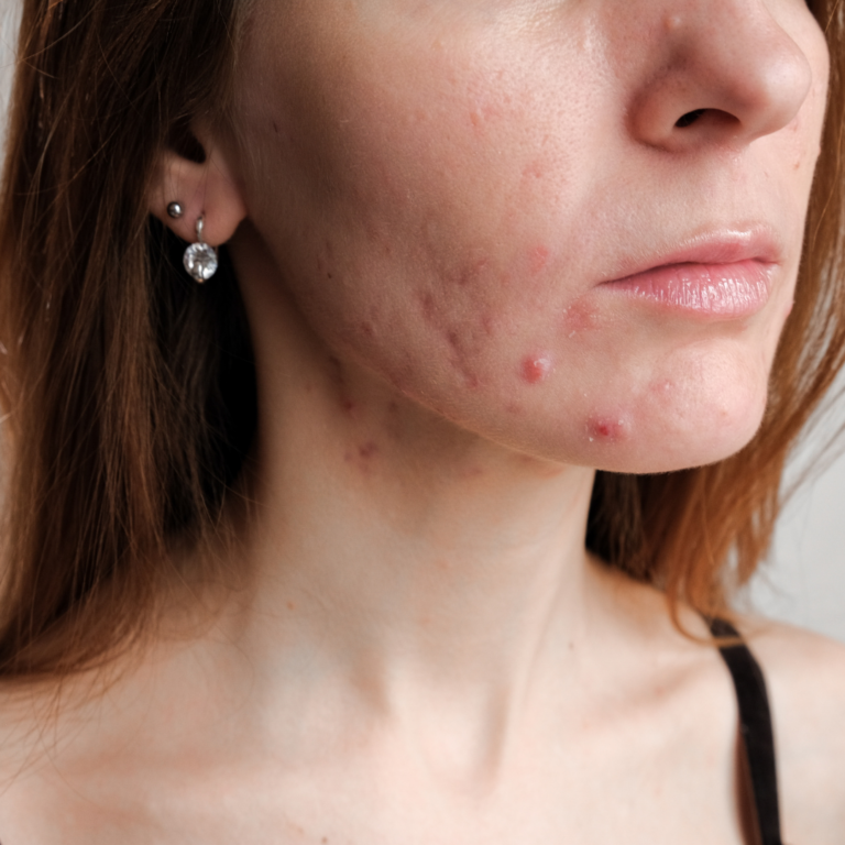 Hormonal vs. Bacterial Acne: Crucial Difference and How to Treat Them