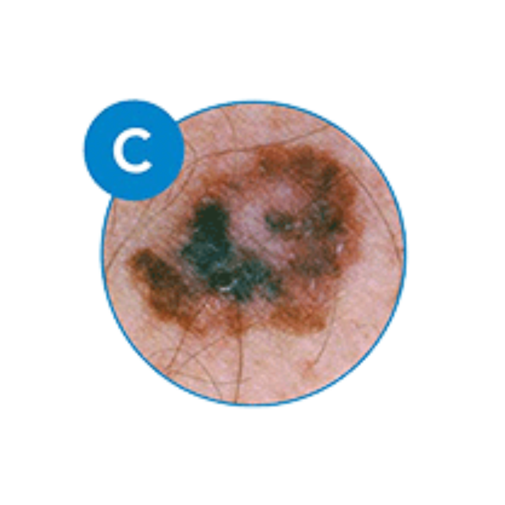 The ABCDEs of Melanoma: A Visual Guide to Spotting Potentially Cancerous Skin Lesions | Hudson ...