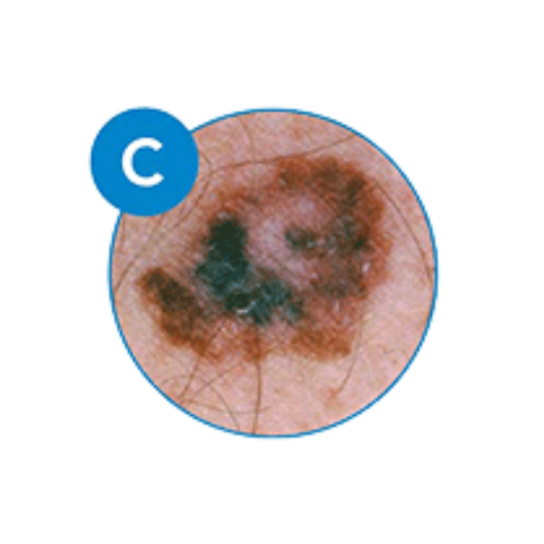 The ABCDEs of Melanoma: A Visual Guide to Spotting Potentially ...