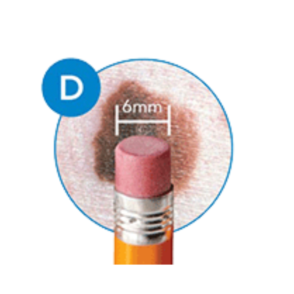 The ABCDEs of Melanoma: A Visual Guide to Spotting Potentially ...