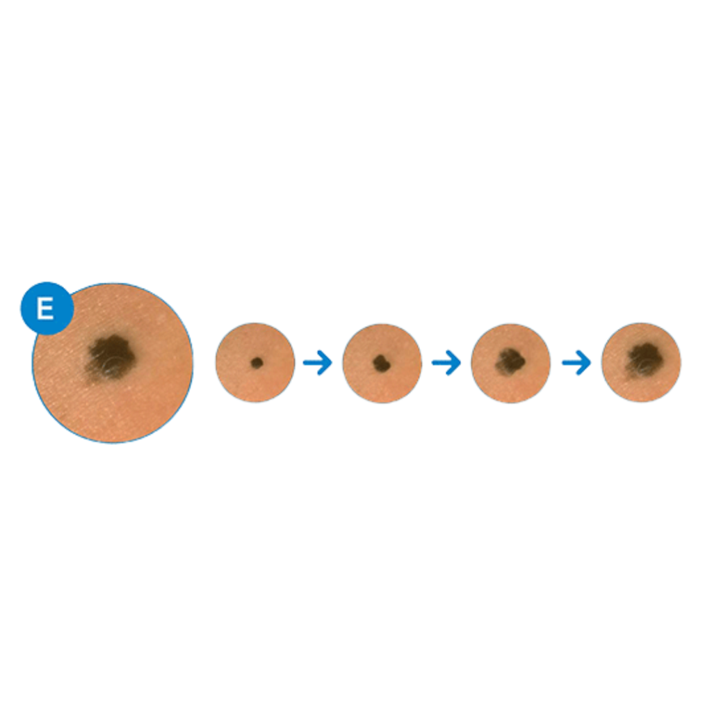 The ABCDEs of Melanoma: A Visual Guide to Spotting Potentially ...
