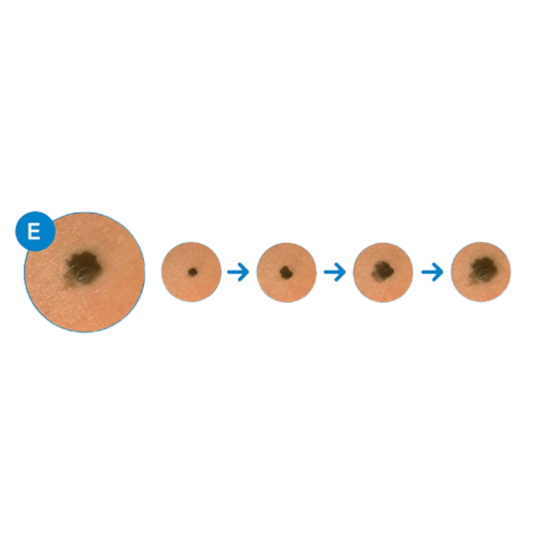 The ABCDEs of Melanoma: A Visual Guide to Spotting Potentially ...