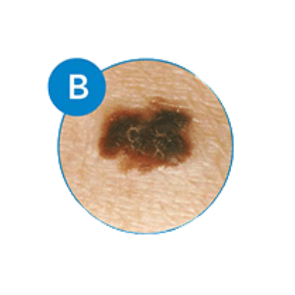 The ABCDEs of Melanoma: A Visual Guide to Spotting Potentially ...
