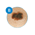 The ABCDEs of Melanoma: A Visual Guide to Spotting Potentially ...